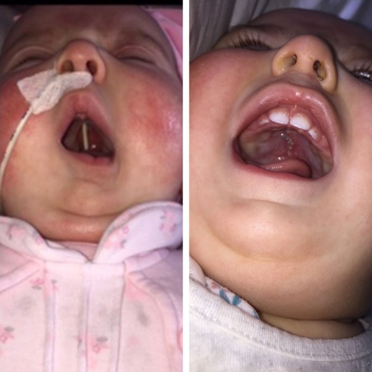 Cleft Lip and Palate | The GP Infant Feeding Network (UK)